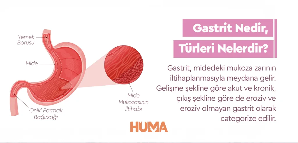 Gastrit Nedir? Belirtileri, Nedenleri ve Tedavi Yöntemleri